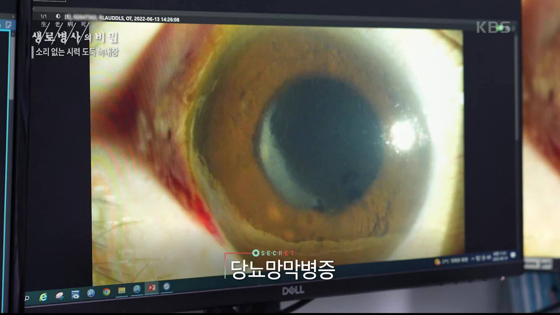 녹내장 고위험군으로부터 시력을 지켜라! | KBS 220831 방송 | 보다
